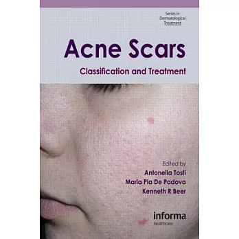 博客來-Acne Scars: Classification and Treatment