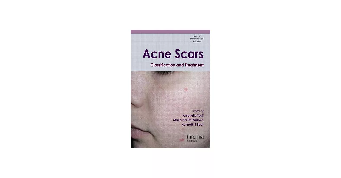 博客來-Acne Scars: Classification and Treatment